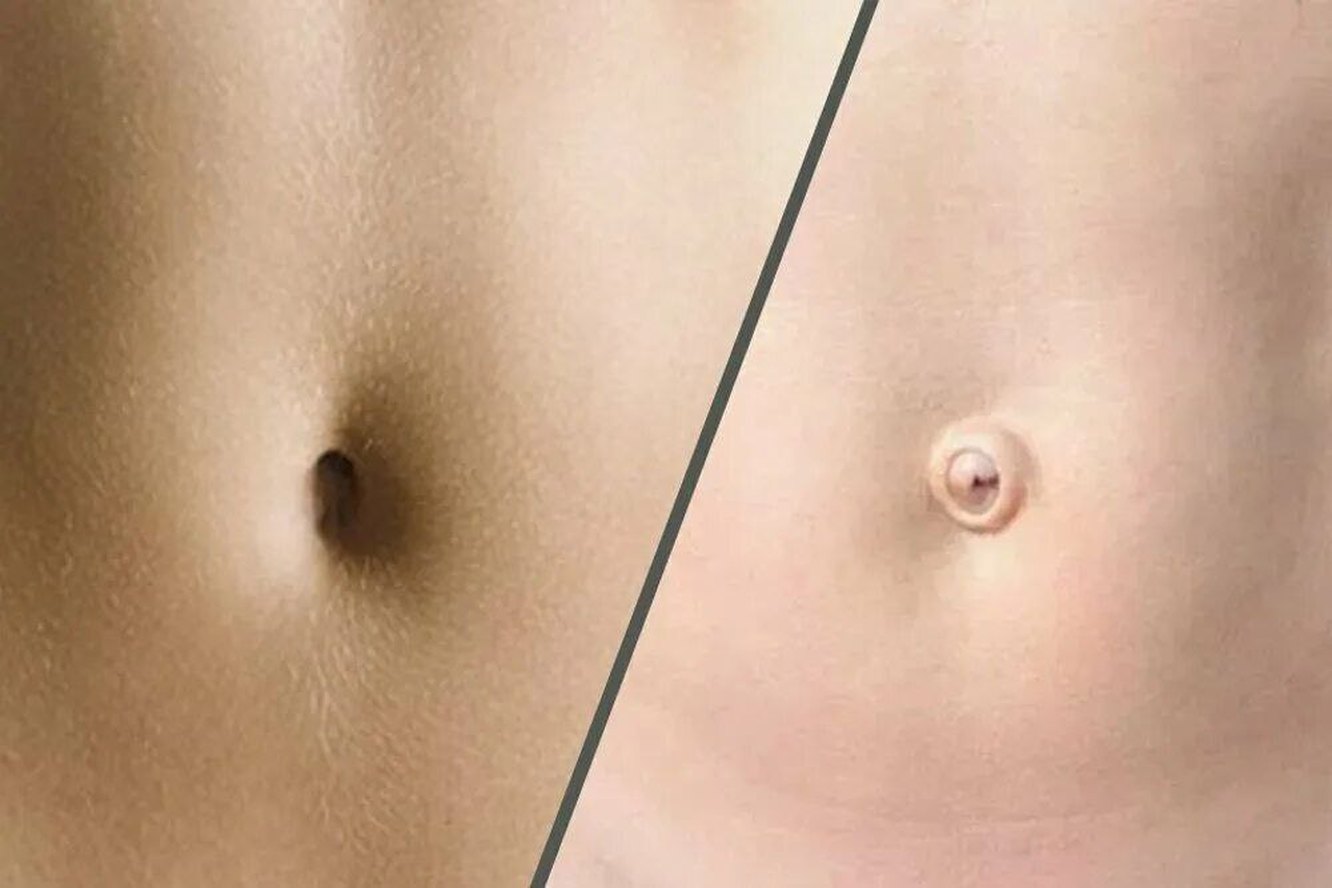 Belly Buttons Innie Vs Outie